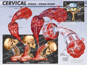 Cervical Sprain Strain Injury 2