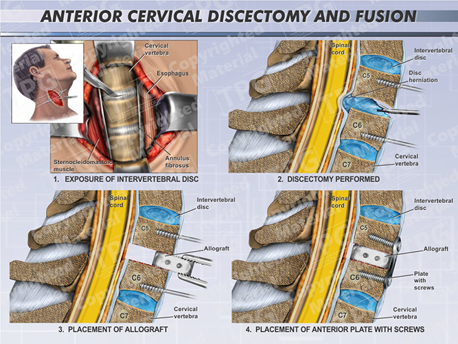 Anterior Cervical Discectomy Fusion Male One Level