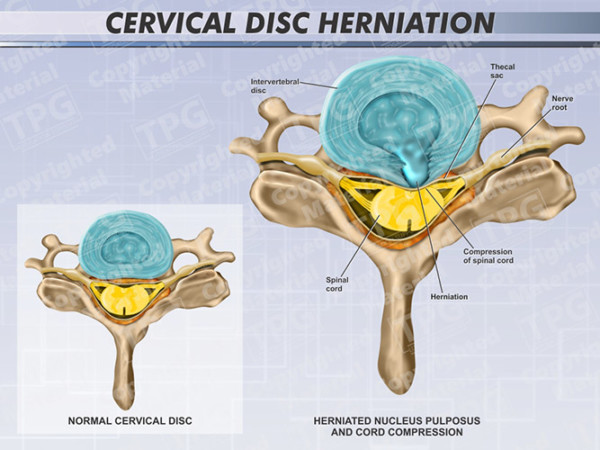 Cervical Discography Procedure at C3-4 Through C6-7 - Order