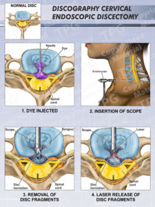 Discography Cervical Endoscopic Discectomy - Order