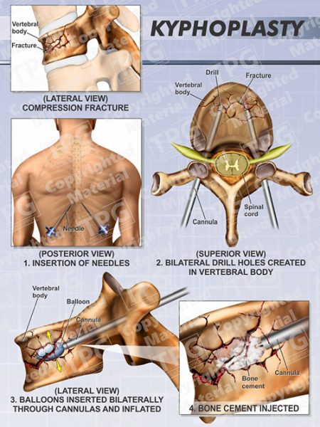 Kyphoplasty - Order