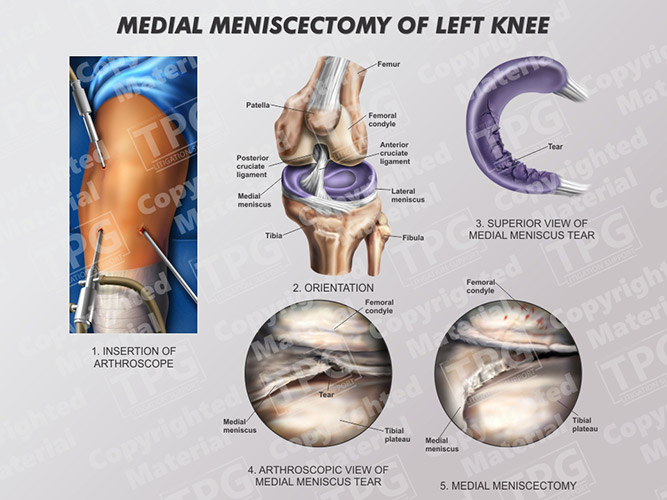 Medial Meniscectomy Of Left Knee Landscape Order