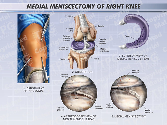 Medial Meniscectomy Of Right Knee Landscape Order Medial Meniscectomy Of Right Knee Landscape Order