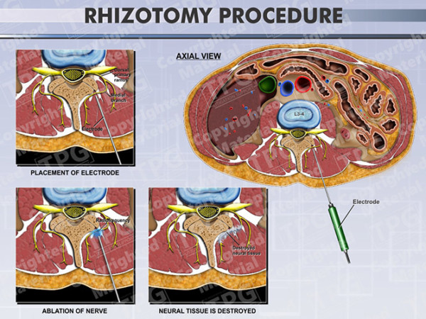 Rhizotomy Procedure - Order