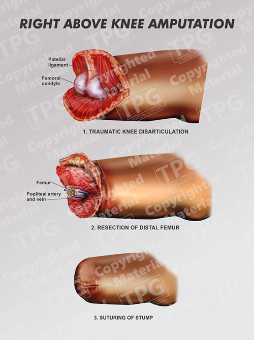 Above Knee Amputation Right Order Above Knee Amputation Right Order