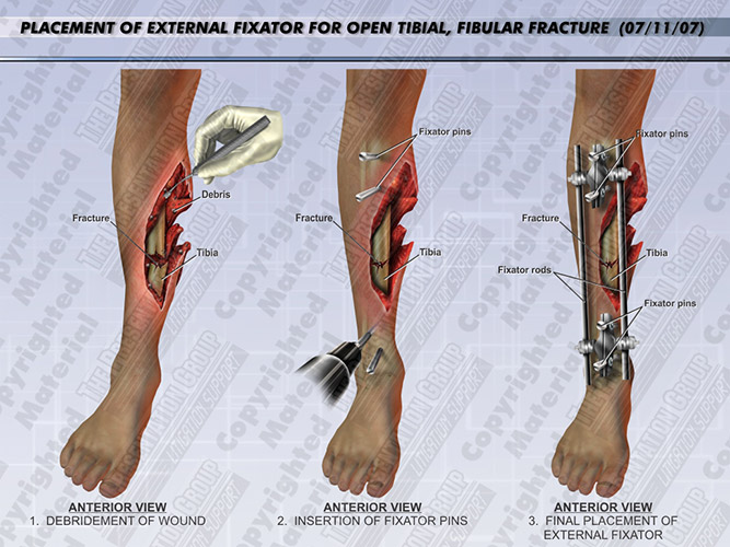 External Fixator Placement Medical Legal Illustration External Fixator Placement Medical Legal Illustration