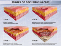 Stages of Decubitus Ulcers - Order