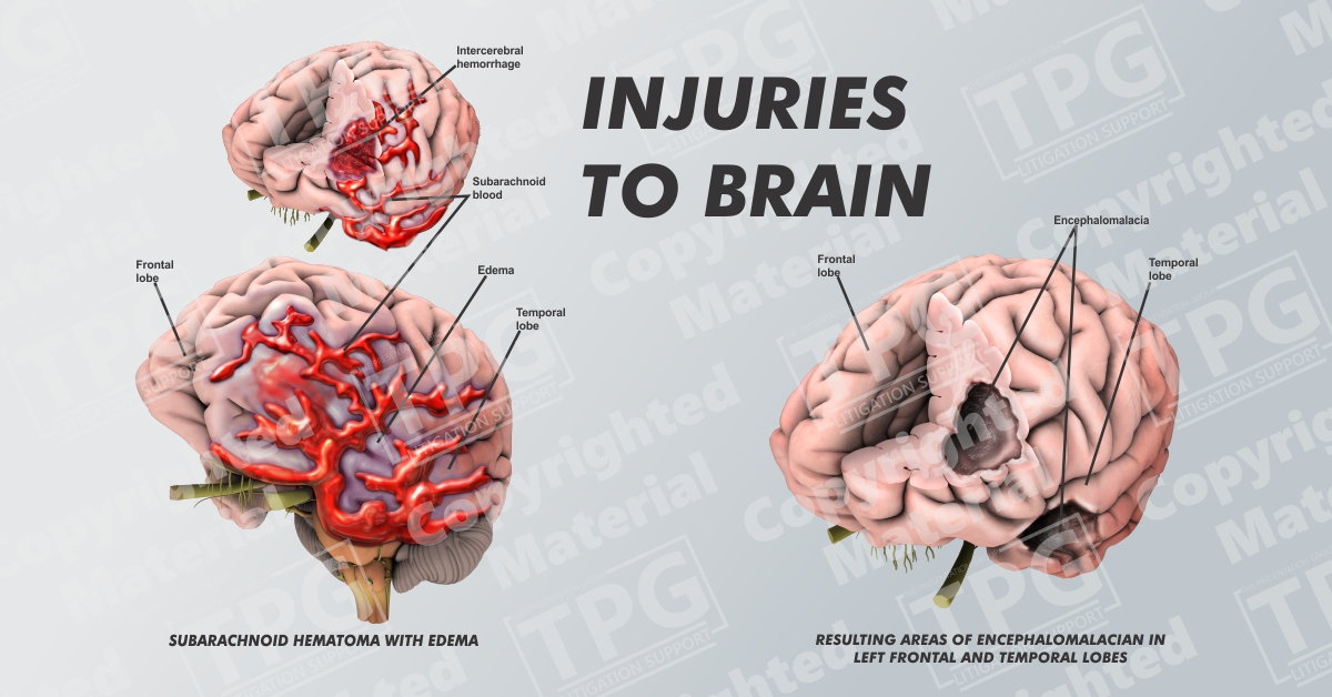 Brain Injury Medical Legal Illustration Social - Presentation Group ...